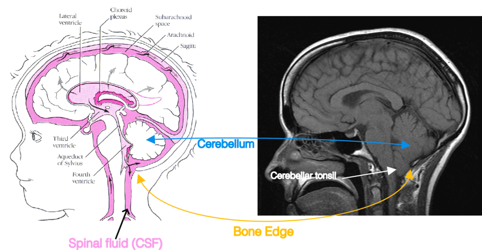 Cerebellar Tonsils Mri